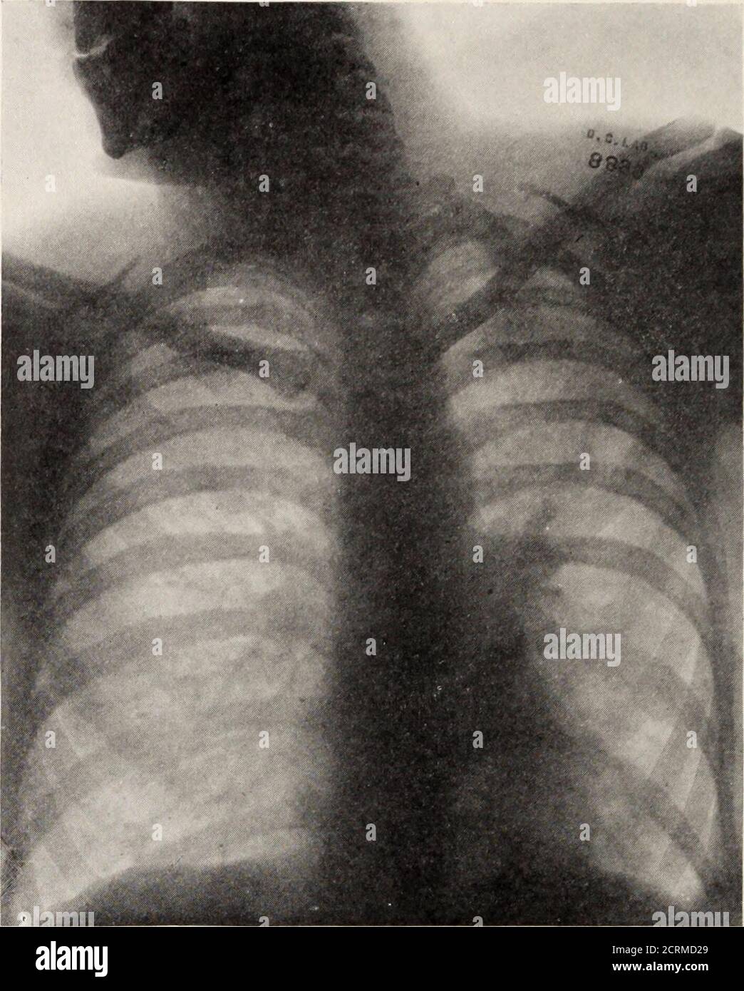 Apical Area Of The Lung