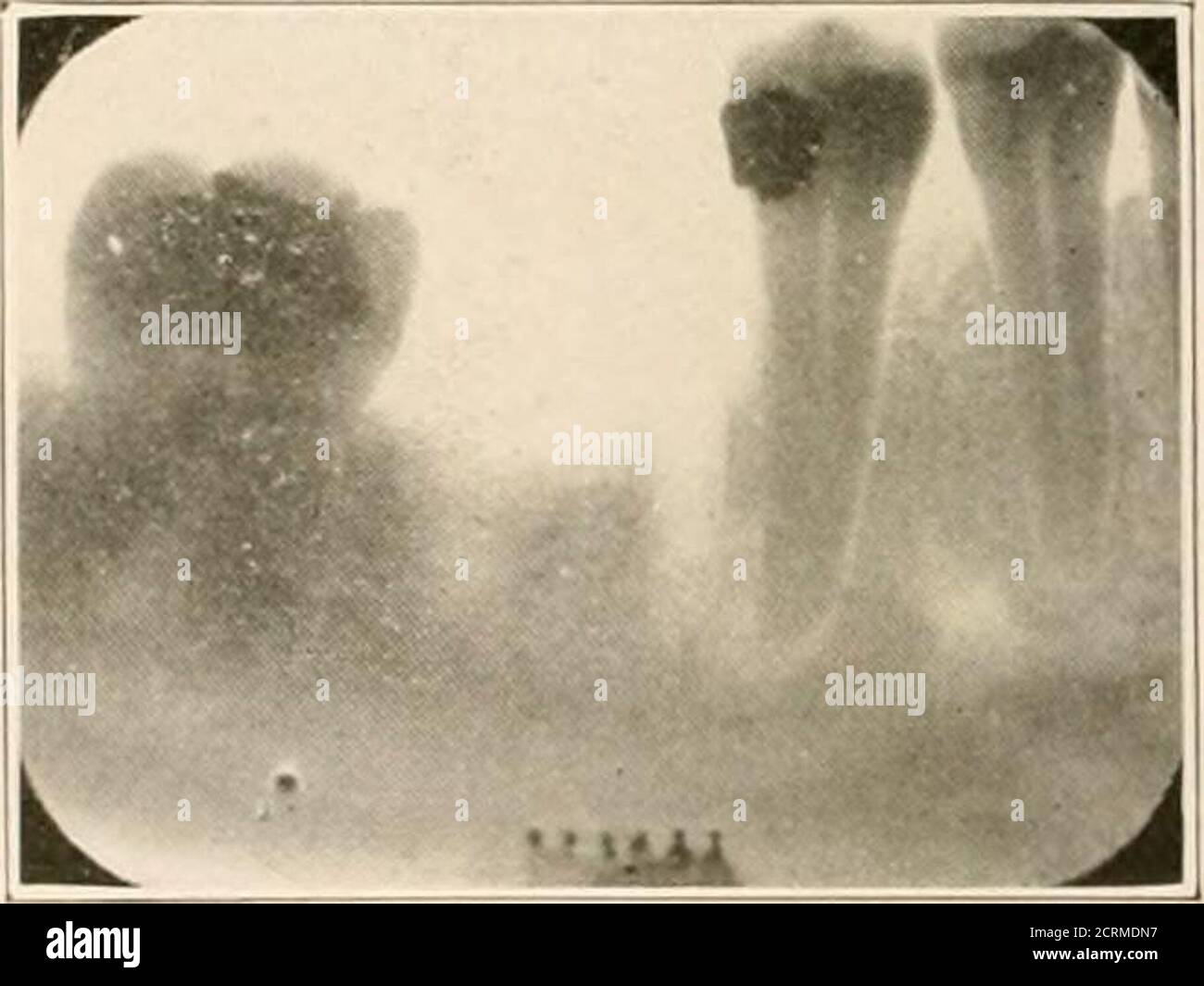 . Oral sepsis in its relationship to systemic disease . Fig. 86. Fig ...