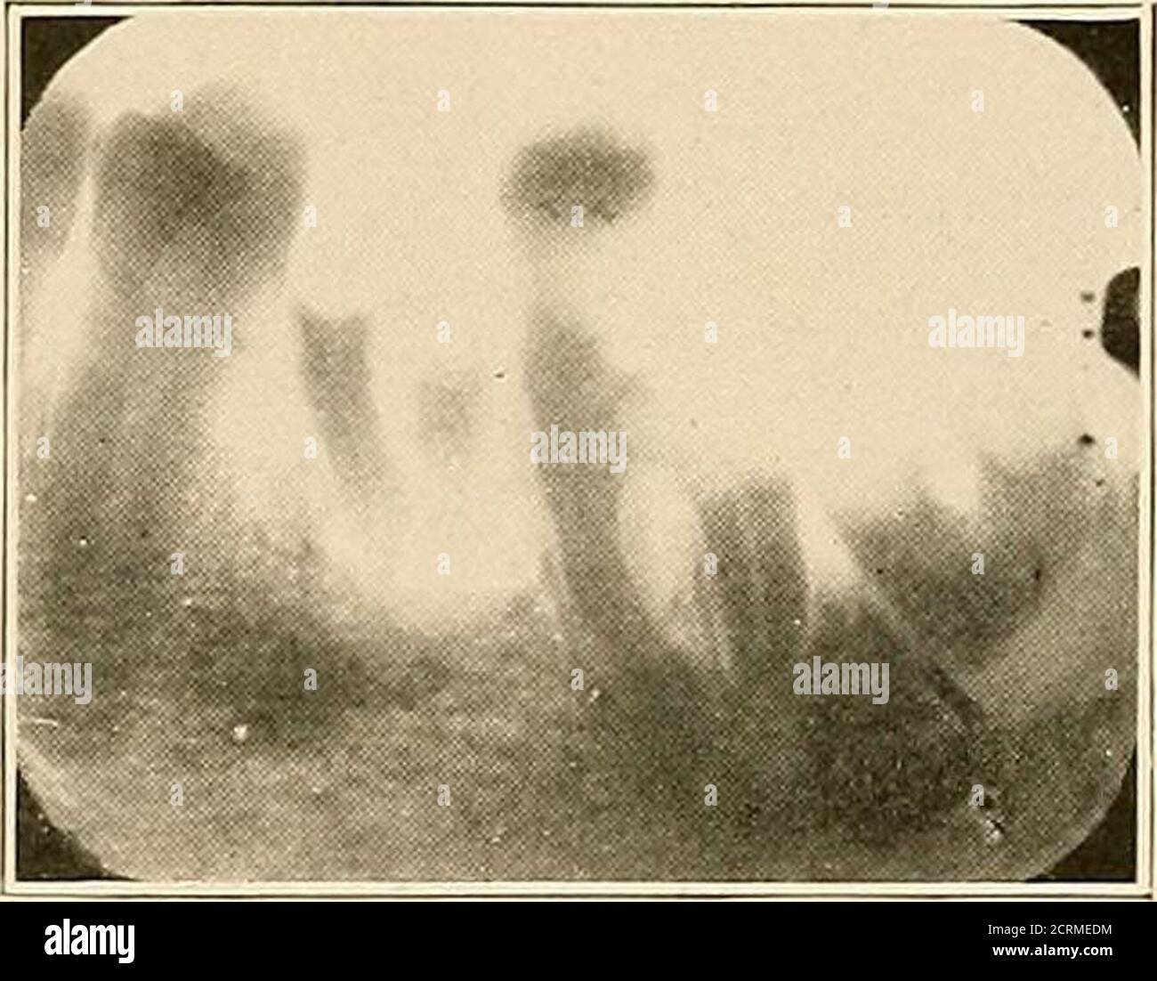 . Oral sepsis in its relationship to systemic disease . Fig. 80. Fig ...