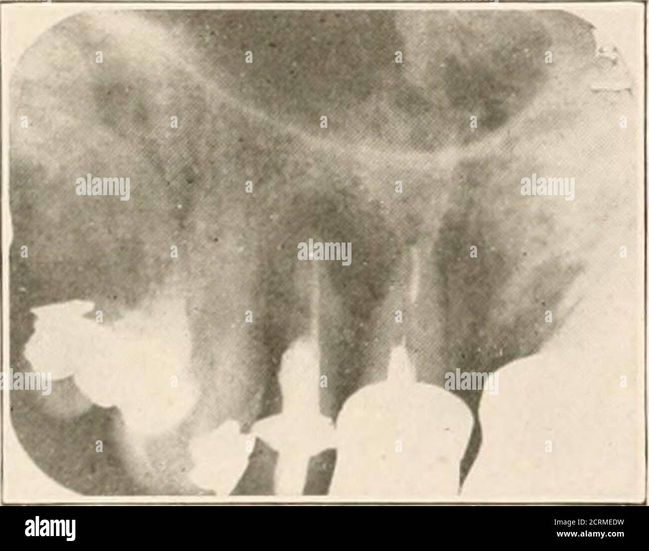 Periapical granuloma hi-res stock photography and images - Alamy