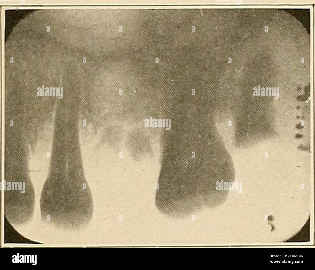 . Oral sepsis in its relationship to systemic disease . Fig. 77.Figs ...