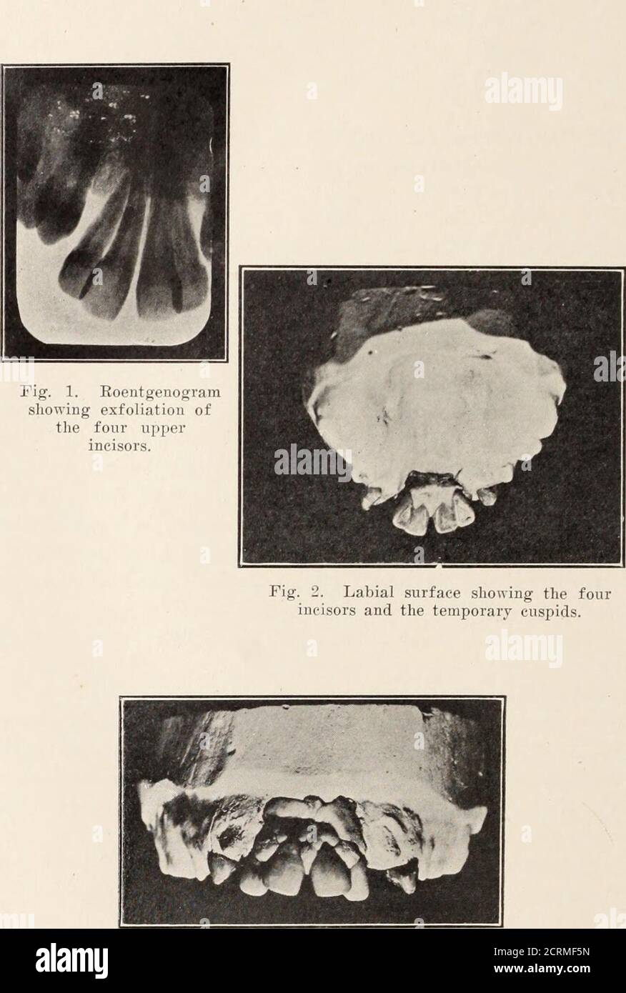 Alveolar fracture hi-res stock photography and images - Alamy