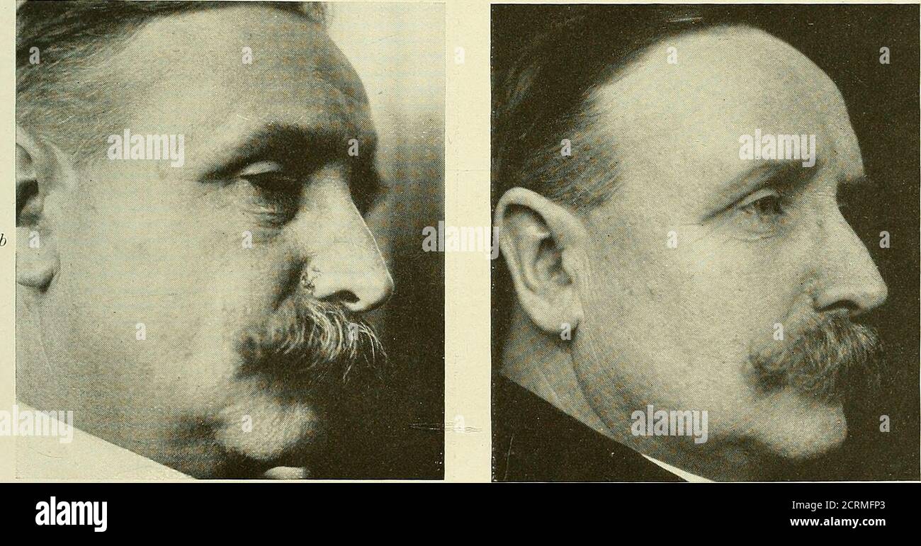 . Radiography and radio-therapeutics . PLATE LXXXIII.—Rodent Ulcers ...