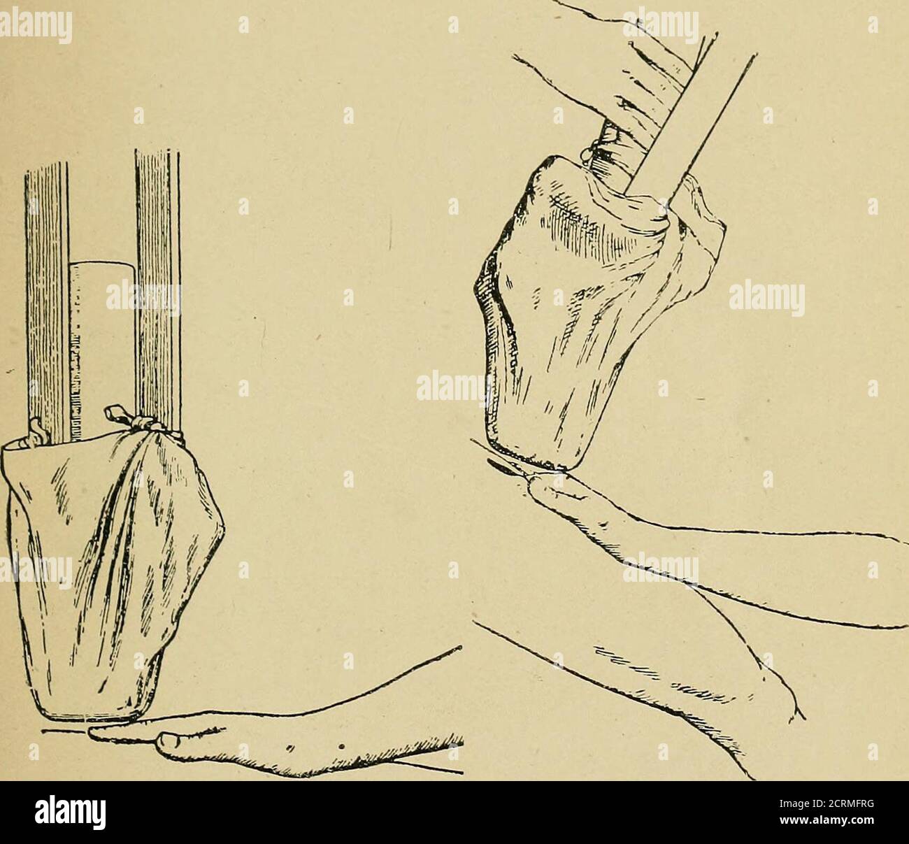 Foreign bodies x ray hi-res stock photography and images - Alamy