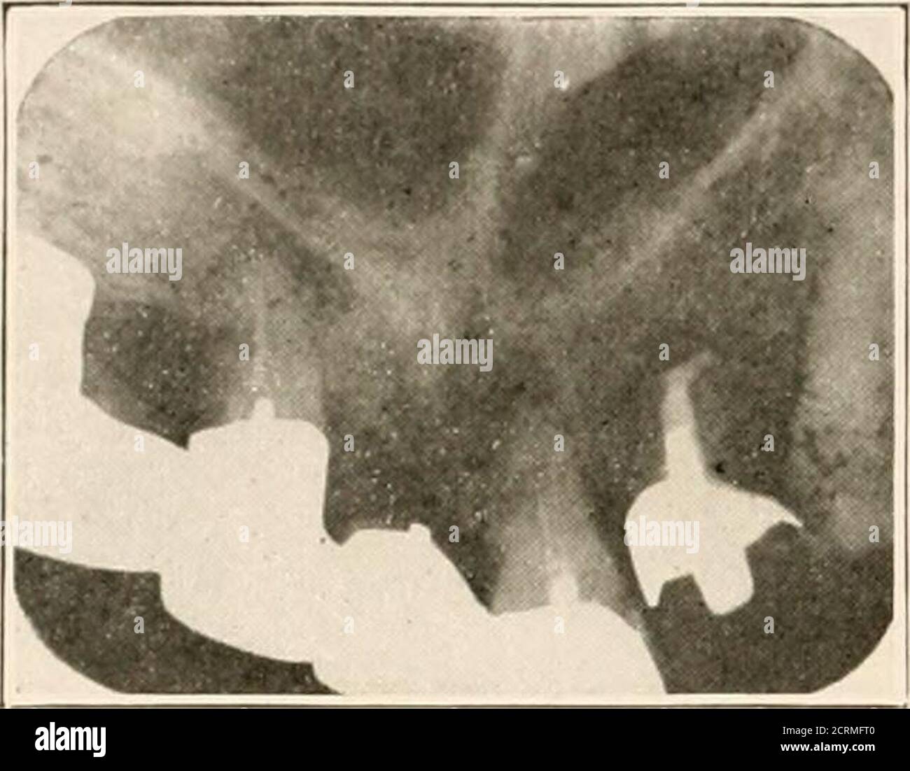 . Interpretation of dental & maxillary roentgenograms . Fig. 56. Fig ...