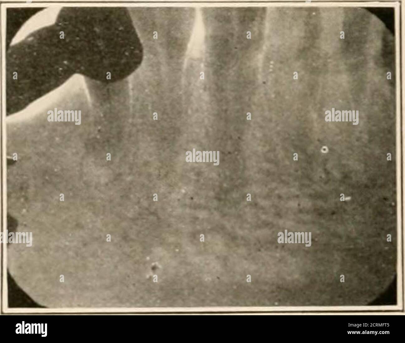 . Oral sepsis in its relationship to systemic disease . Fig. 70.. Fig ...