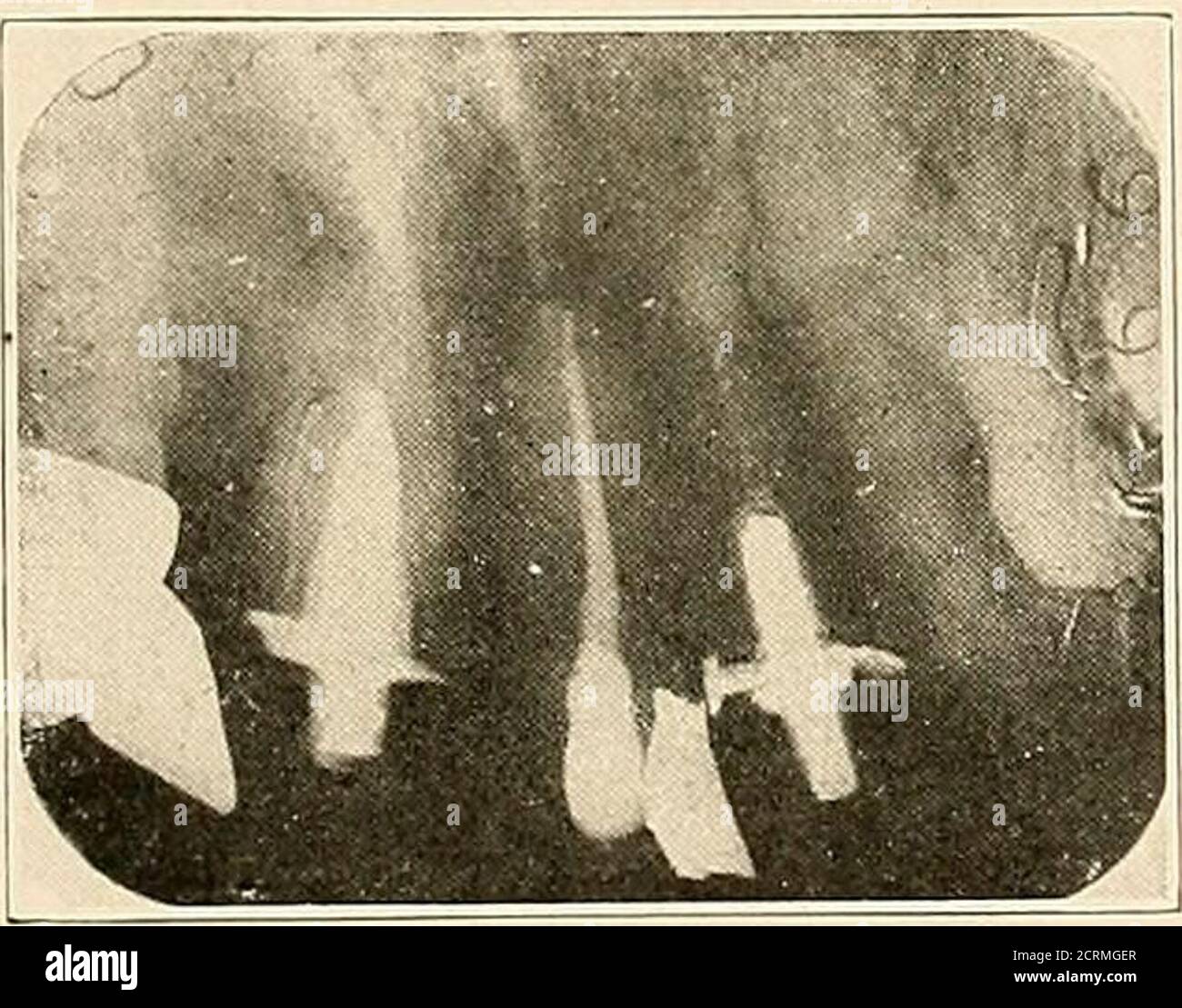 . Interpretation of dental & maxillary roentgenograms . Fig. 54. Fig ...