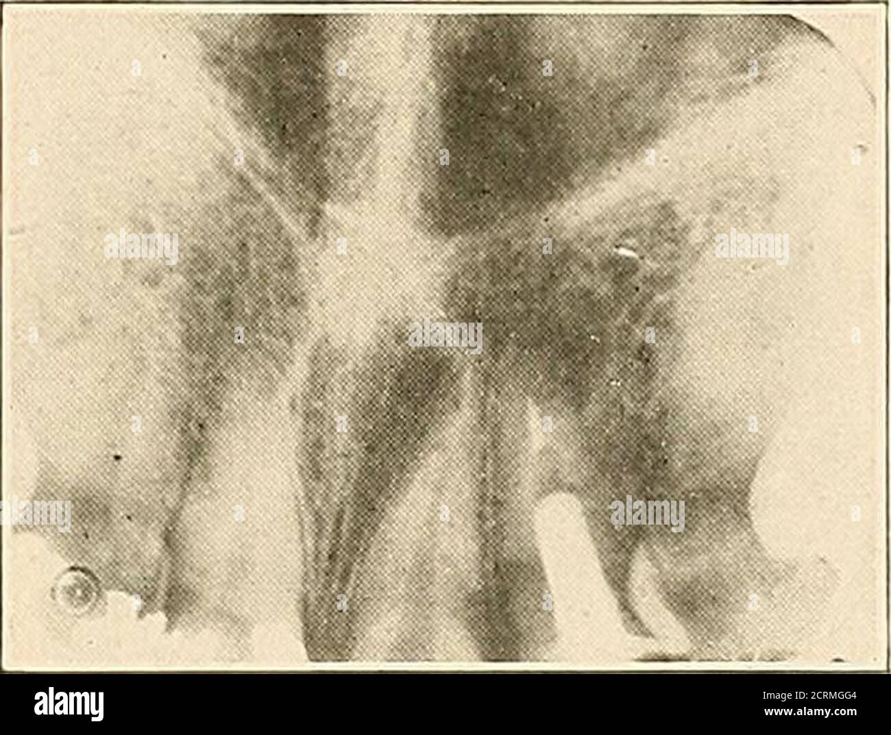 . Interpretation of dental & maxillary roentgenograms . Fig. 54. Fig ...