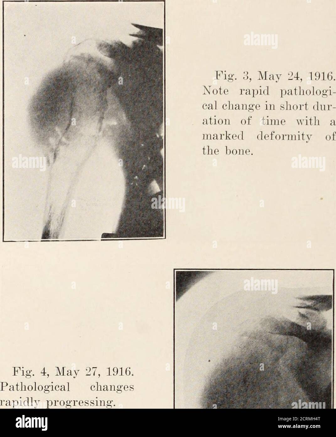 Soft tissue sarcoma hi-res stock photography and images - Alamy