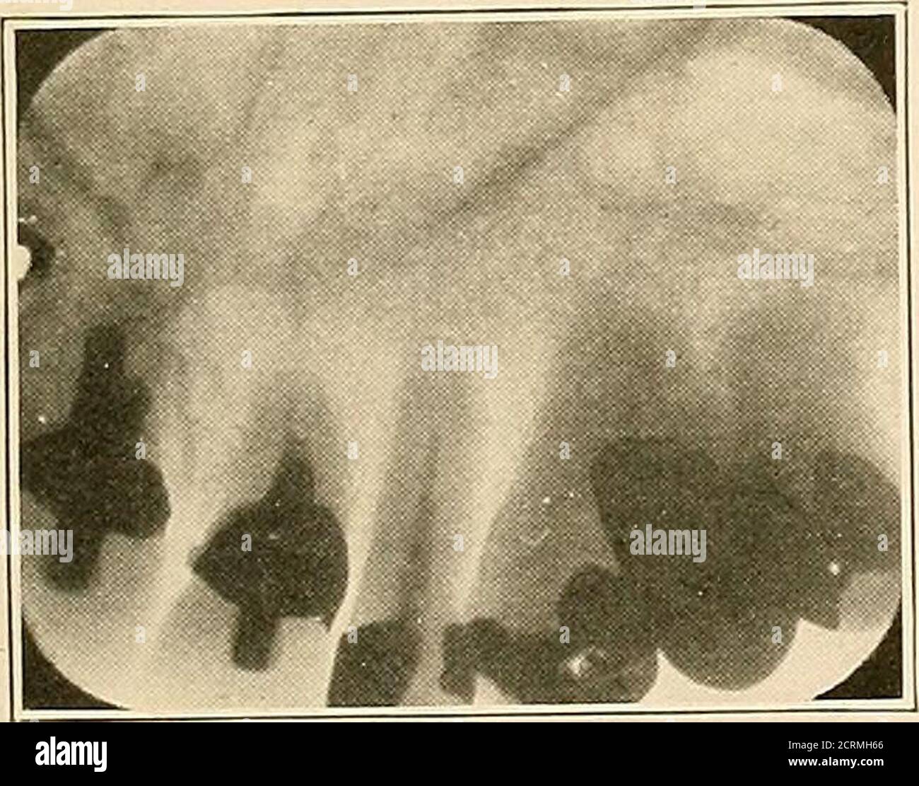 . Oral sepsis in its relationship to systemic disease . Fig. 60. Fig ...