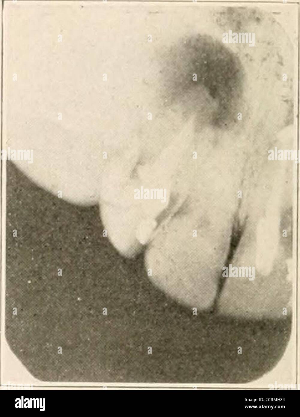 Periapical granuloma hi-res stock photography and images - Alamy