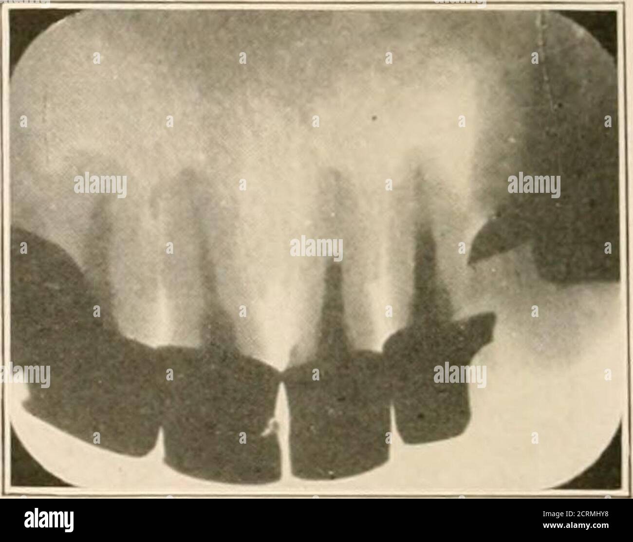 . Oral sepsis in its relationship to systemic disease . Fig. 56. Fig ...