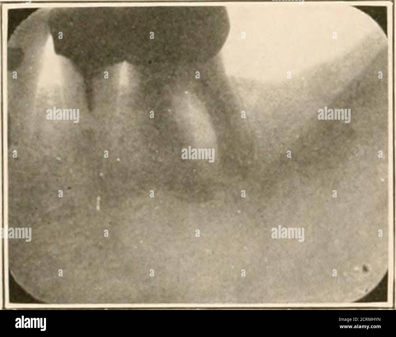 . Oral sepsis in its relationship to systemic disease . Fig. 56. Fig ...