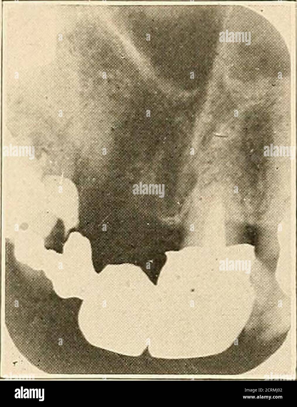 . Interpretation of dental & maxillary roentgenograms . Fig. 46. Fig ...