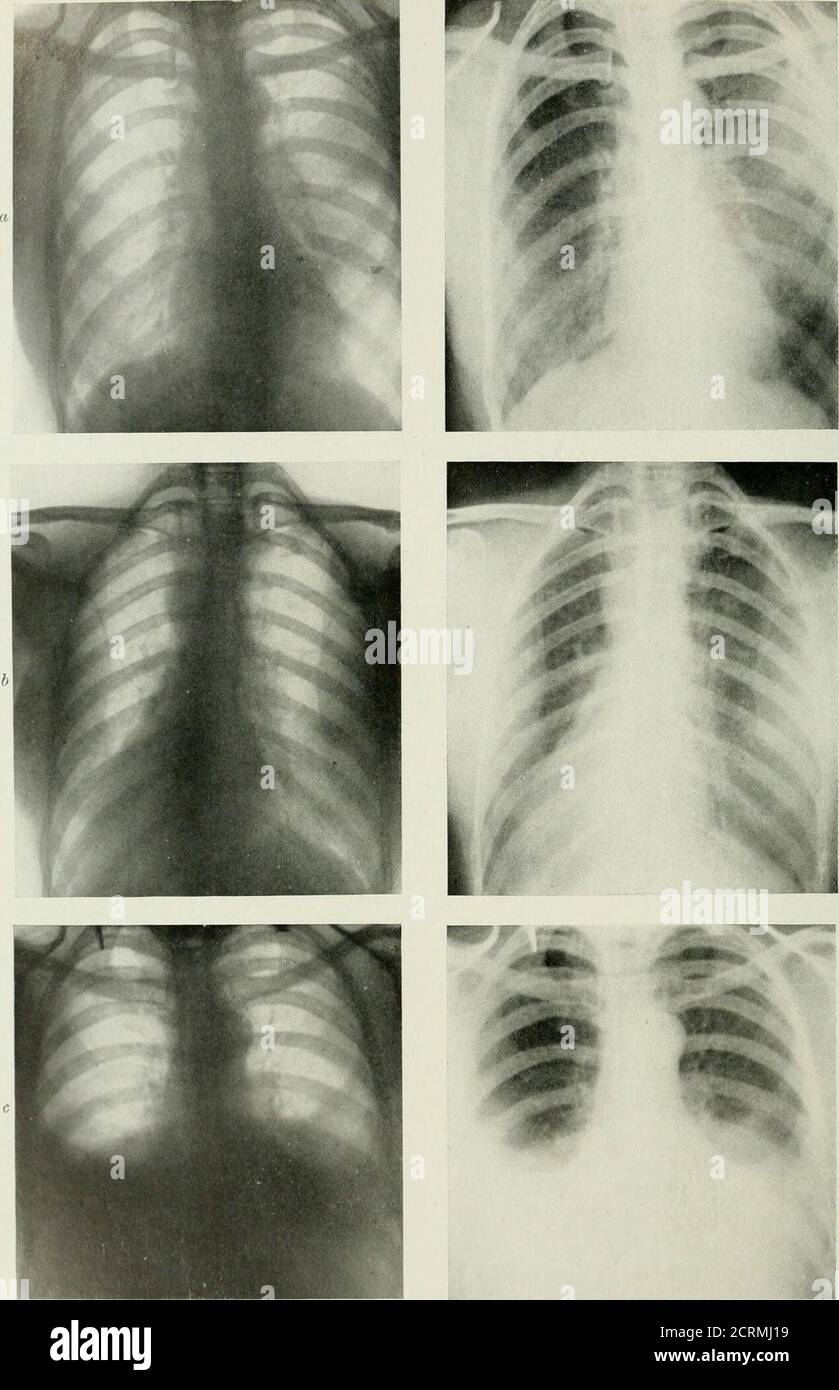 . Radiography and radio-therapeutics . PLATE LVll.—Chests showing ...
