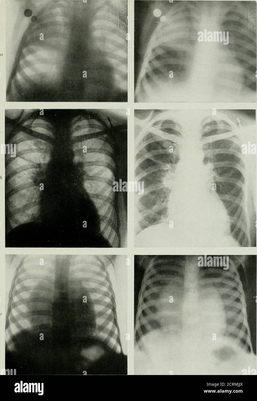 Radiografia Lateral Do Torax
