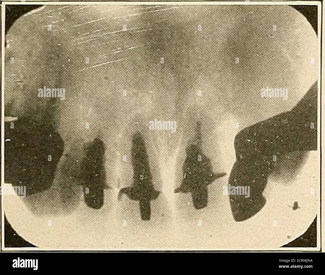 . Oral sepsis in its relationship to systemic disease . Fig. 50. Fig ...