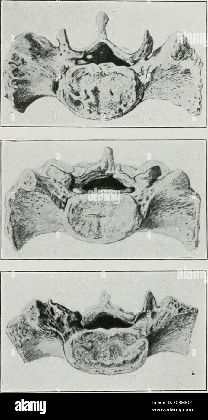 Spondylolis hi-res stock photography and images - Alamy
