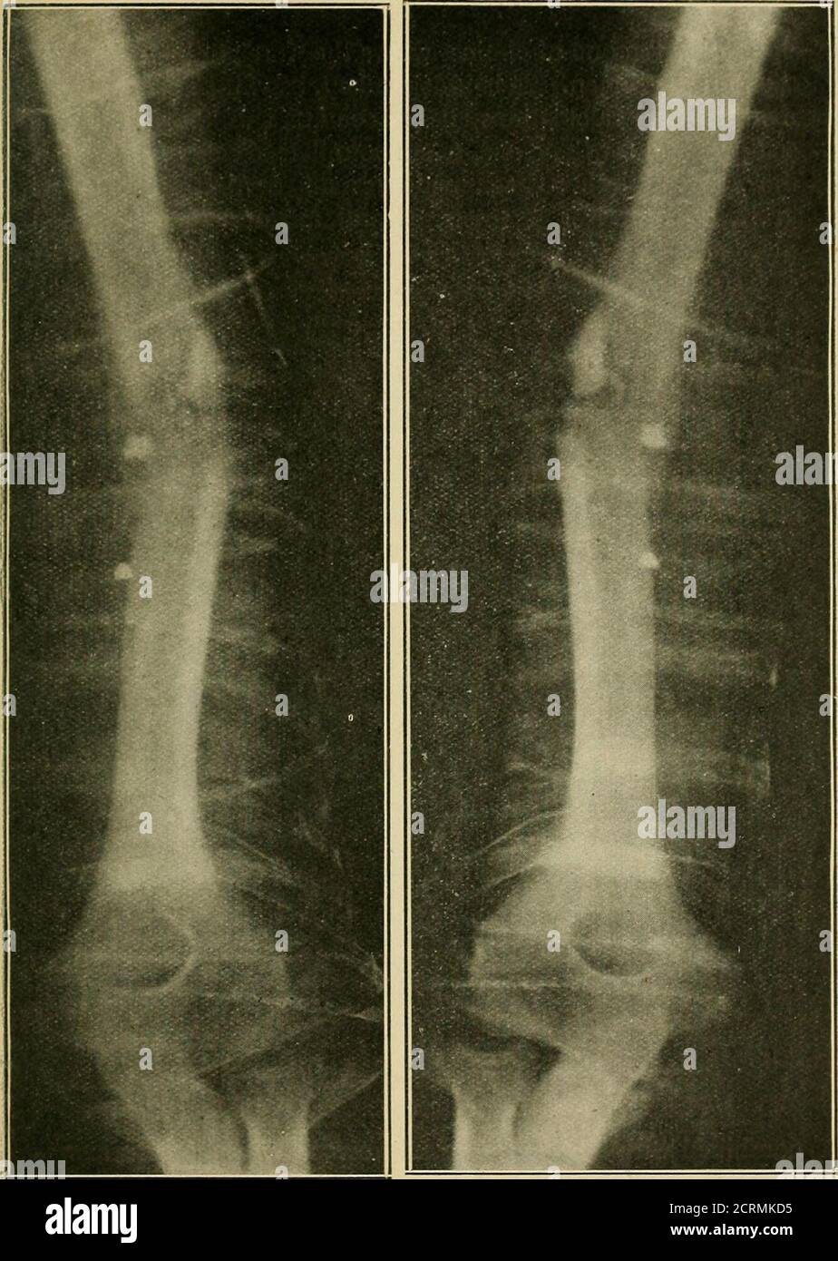 Foreign bodies x ray hi-res stock photography and images - Alamy