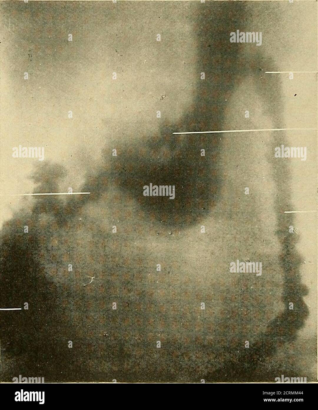 Transverse colon position hi-res stock photography and images - Alamy