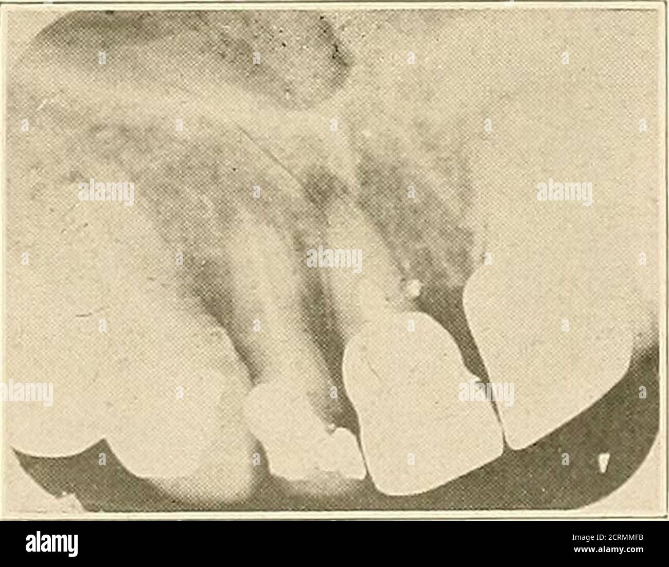 Interpretation Of Dental And Maxillary Roentgenograms Fig 22 D Fig