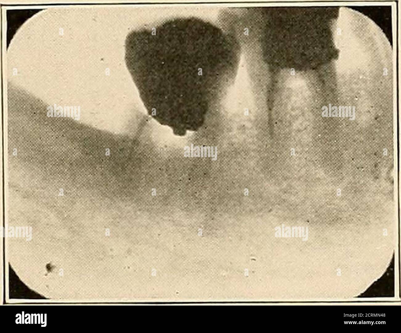 . Oral sepsis in its relationship to systemic disease . Fig. 22. Fig ...