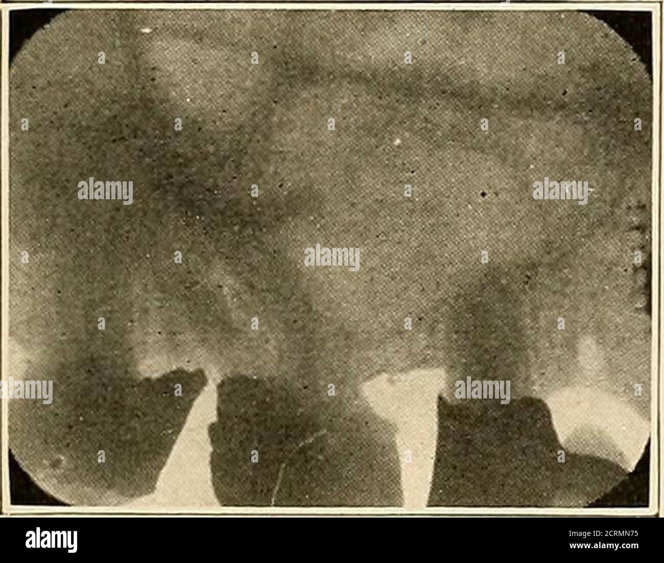 Vincents Angina High Resolution Stock Photography and Images - Alamy