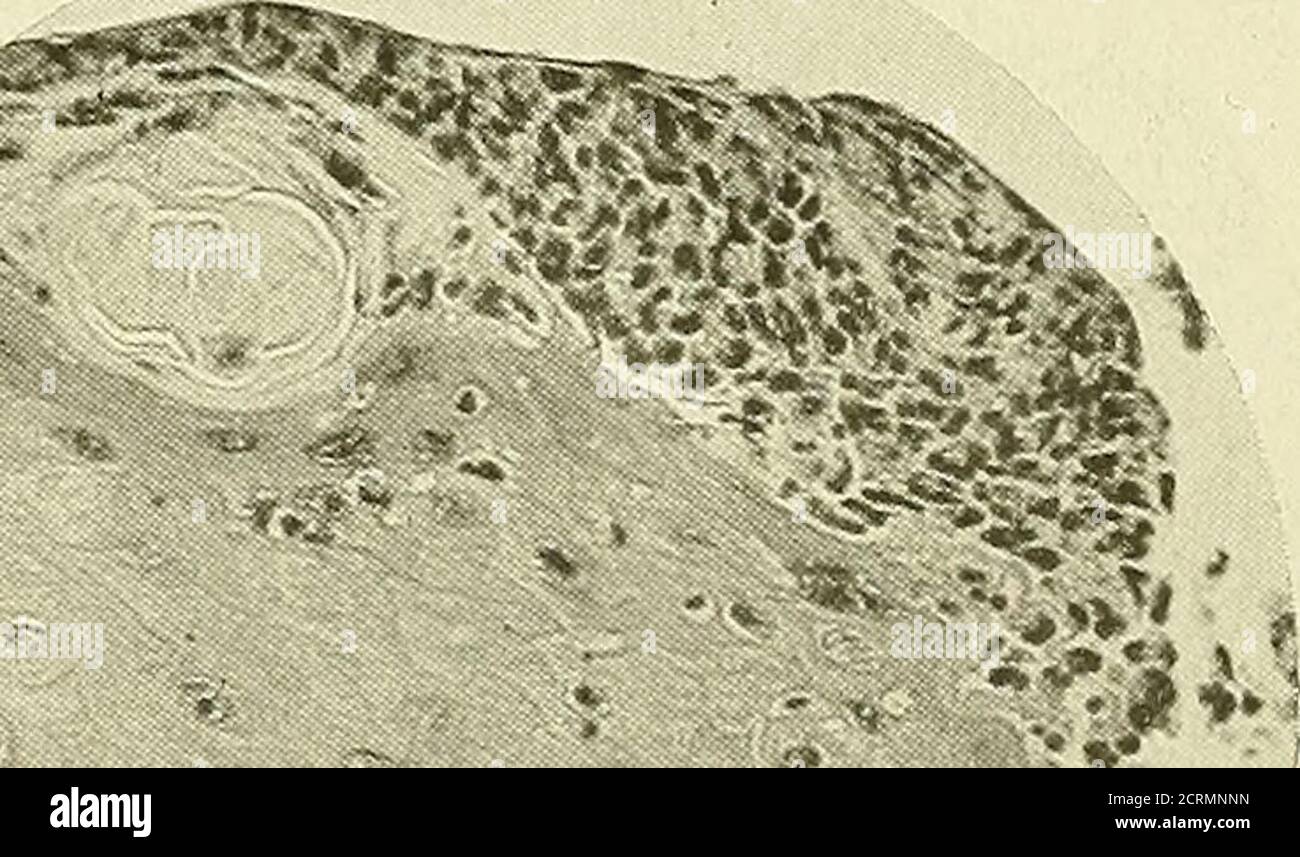 Corneal infiltration hi-res stock photography and images - Alamy