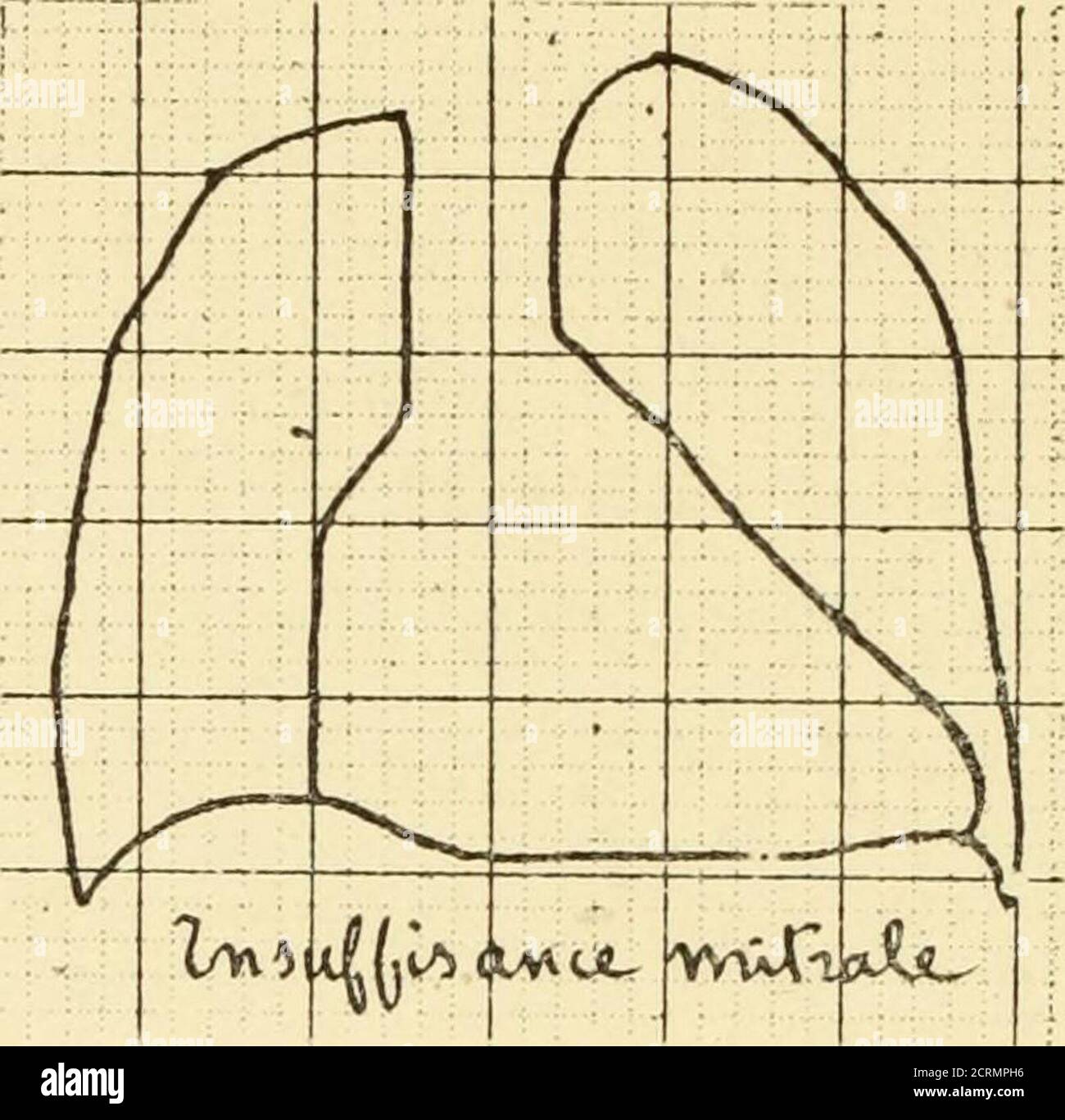 . Les formes de l'aire de projection du coeur pathologique : étude de ...