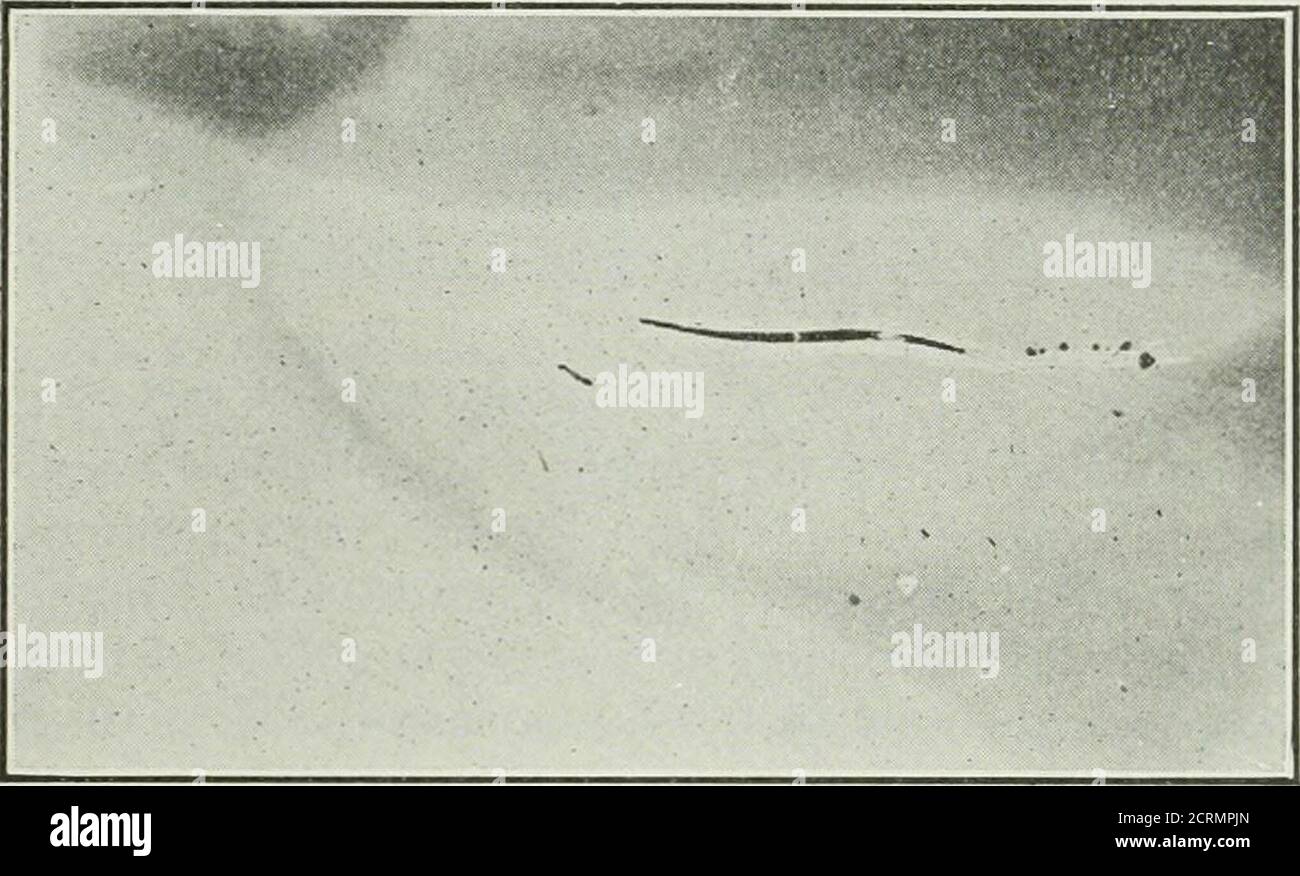 . Radium . Fig. 22.—A, showing sequestrum of lower jaw ...