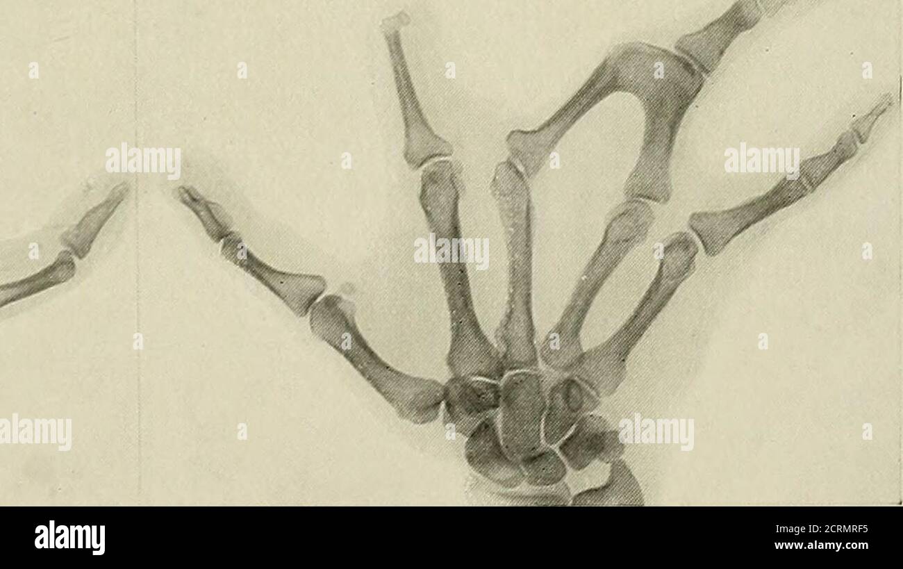 . Radiography and radio-therapeutics . s X. PLATE LXXVIII.—Congenital ...
