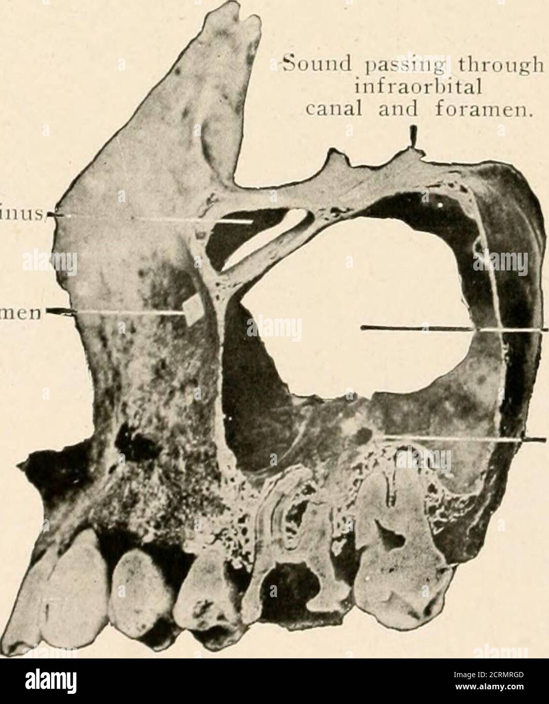 . Interpretation of dental & maxillary roentgenograms . stium maxillare ...