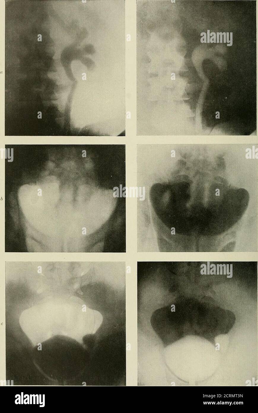 . Radiography and radio-therapeutics . PLATE LXXVI.—Dermoid Ctst in ...