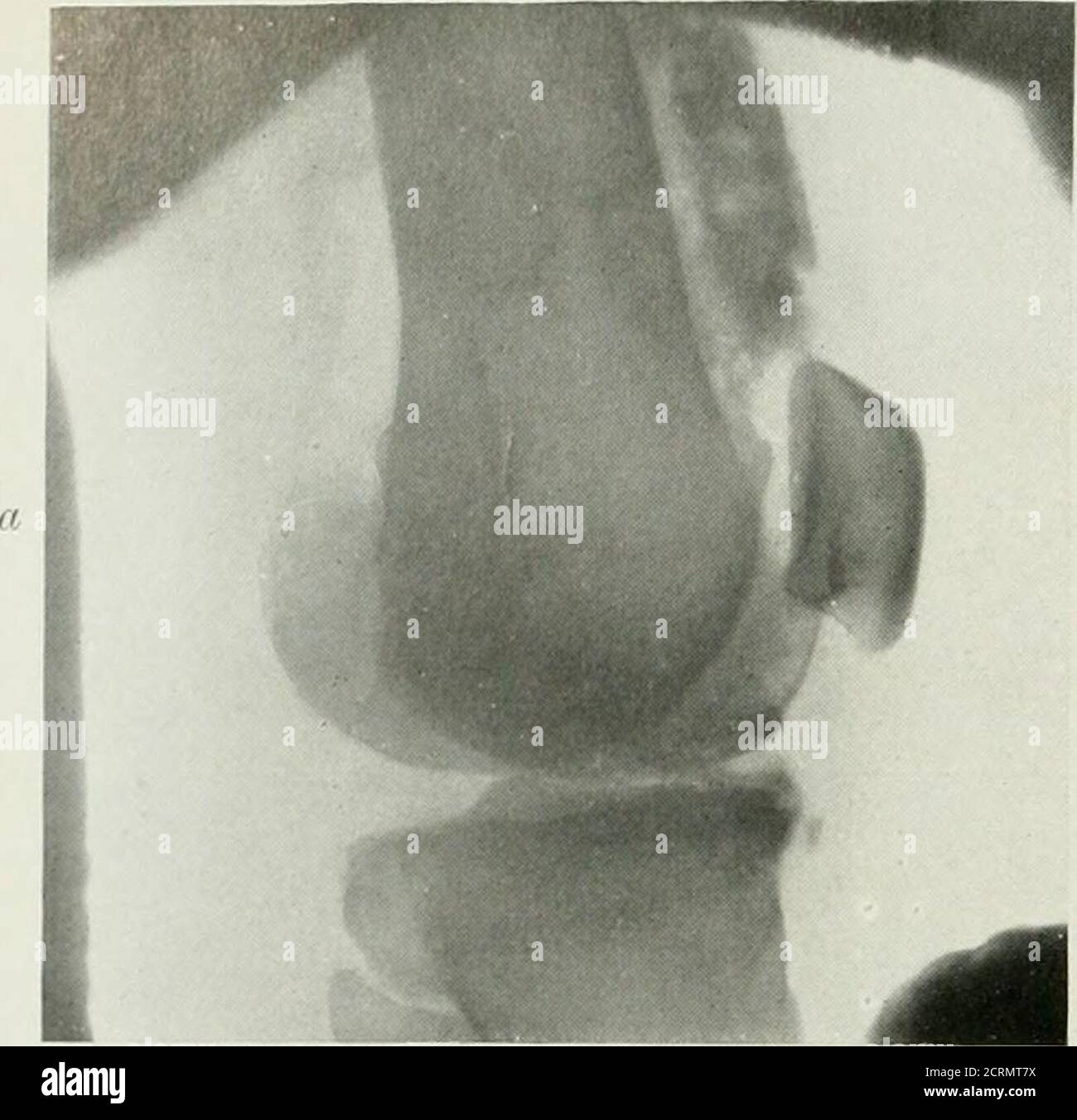 . Radiography and radio-therapeutics . PLATE XLII.—Tuberculosis of ...