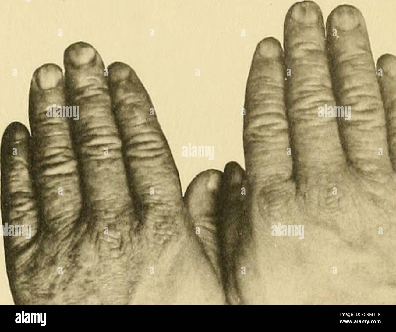 . The surgical treatment of X-ray carcinoma and other severe X-ray ...