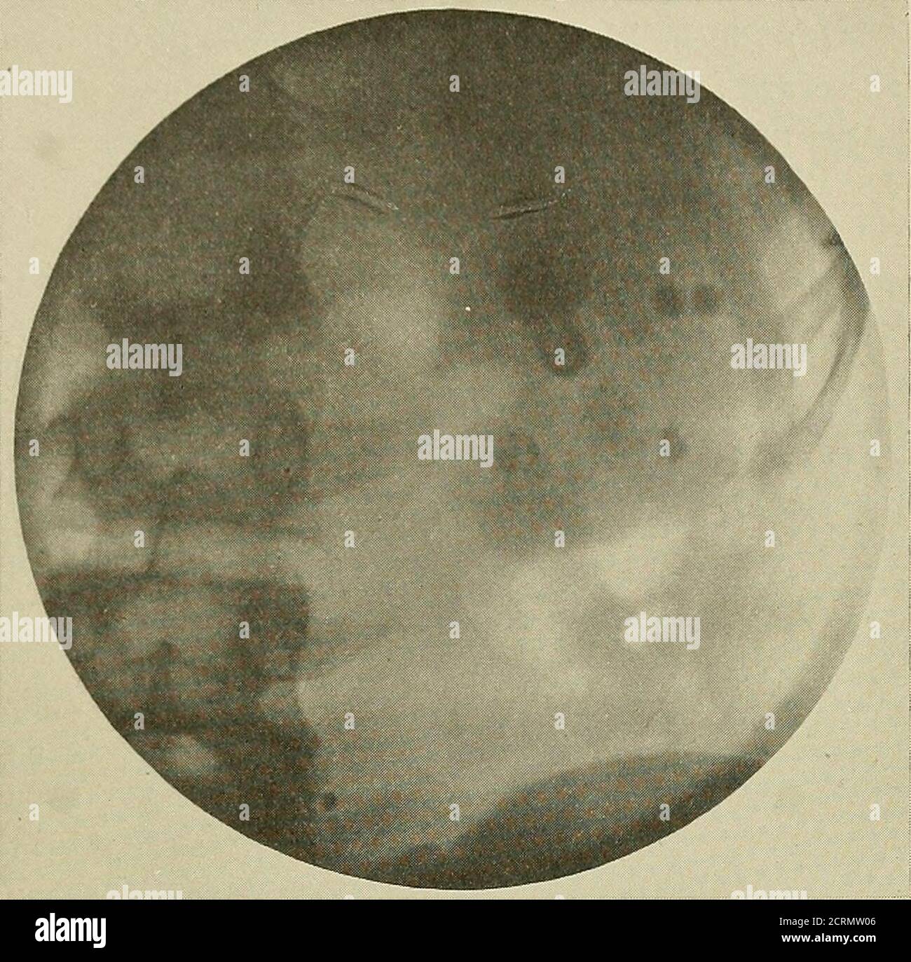 . Radiography and radio-therapeutics . PLATE LXXV.—Urinary Calculi and ...