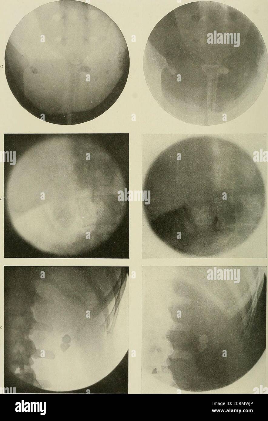 . Radiography and radio-therapeutics . PLATE LXXIV.— Urinary Calculi. a ...