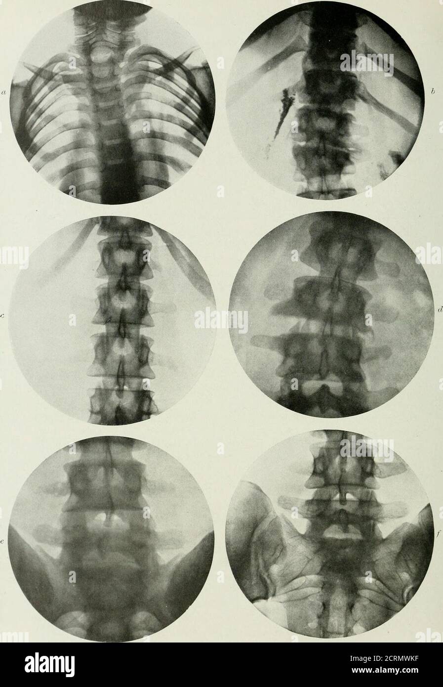 Transverse process fracture hi-res stock photography and images - Alamy