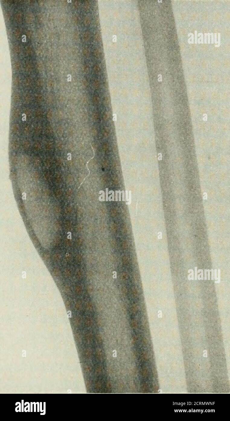 . Radiography and radio-therapeutics . n as to whenand where to operate ...