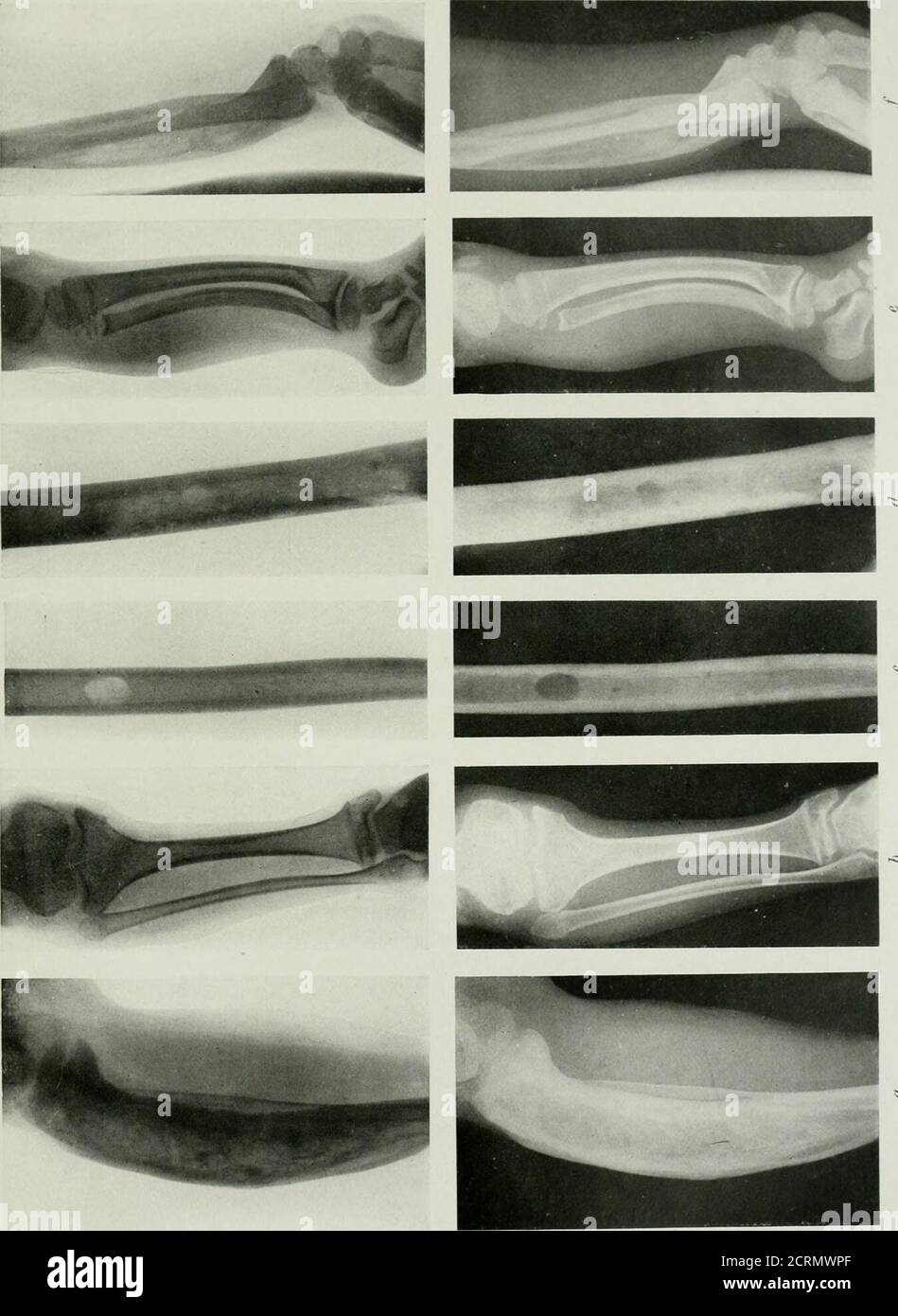 . Radiography and radio-therapeutics . itis,probably tuberculous in ...