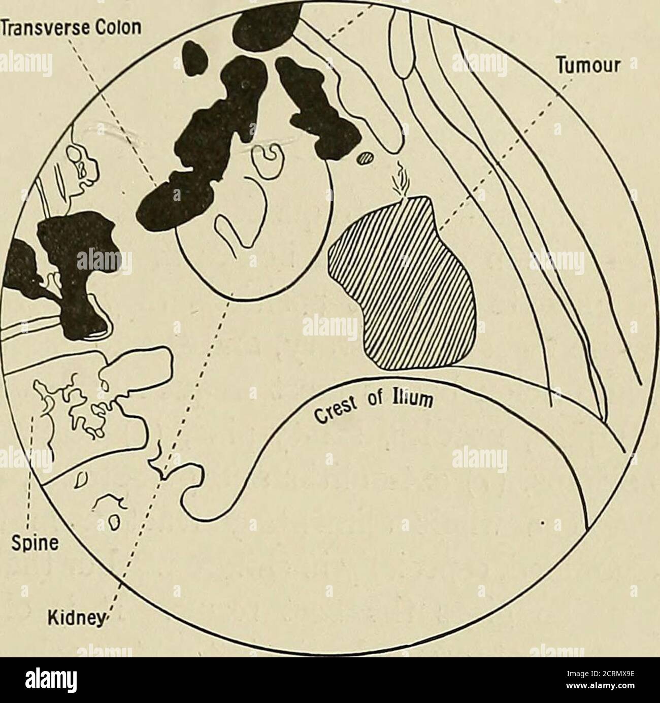 . Radiography and radio-therapeutics . Fig. 310.—Dilatation due to ...