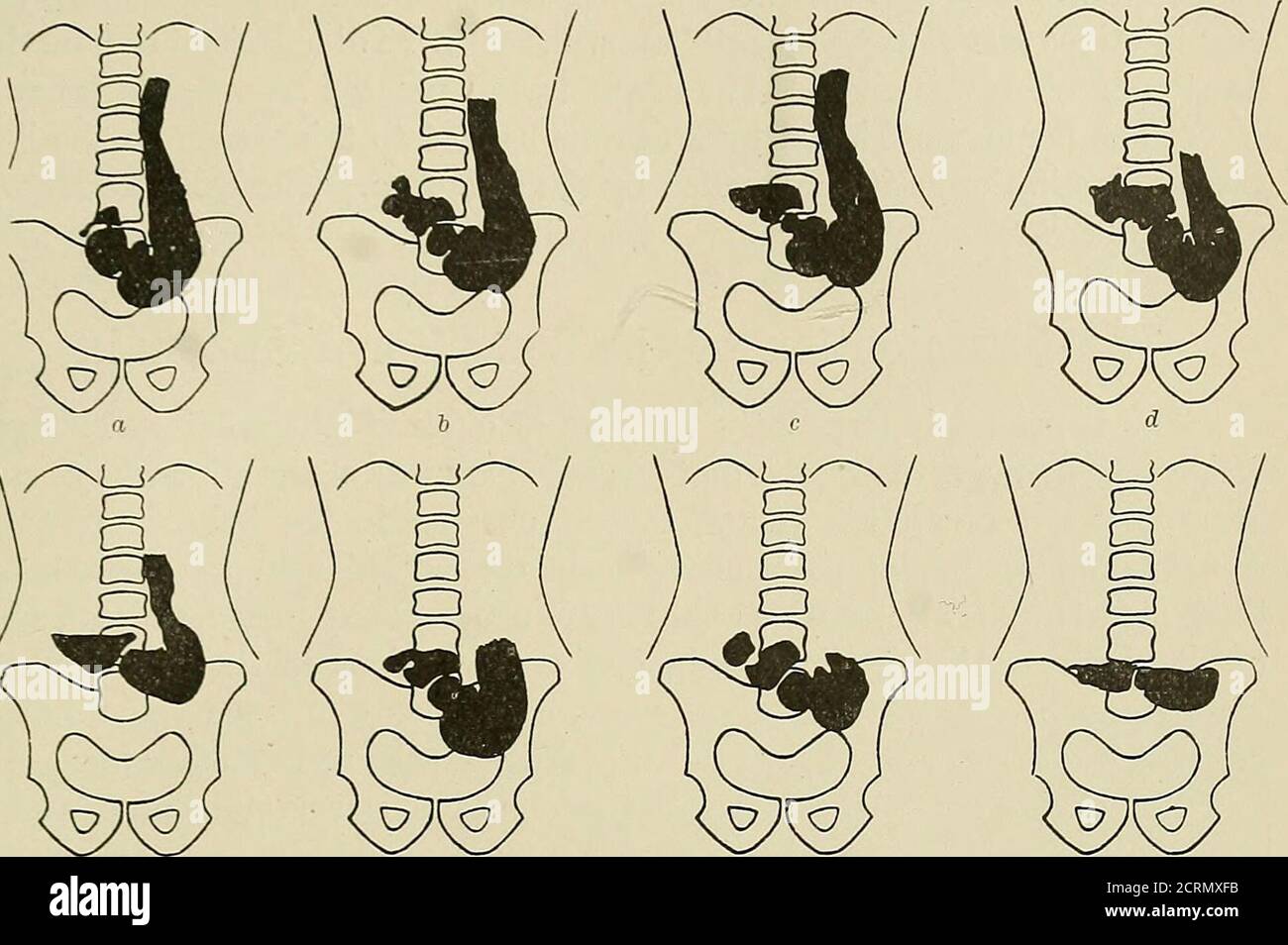 . Radiography and radio-therapeutics . PLATE LXXL—Opaque Enema in Colon ...