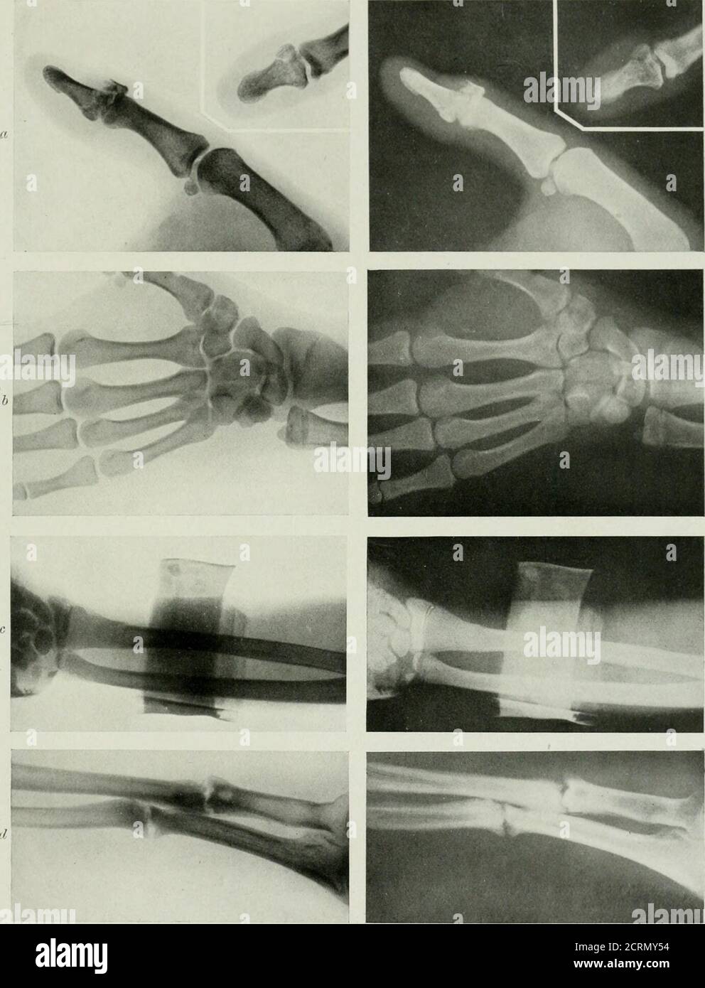 Carpal bones in the wrist hi-res stock photography and images - Alamy
