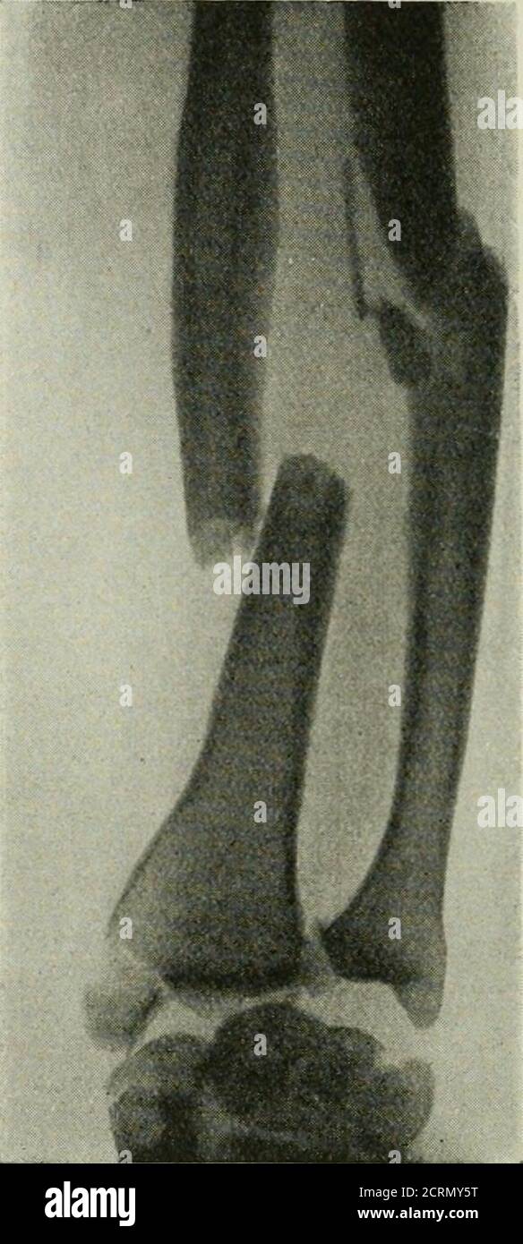 . Radiography and radio-therapeutics . Fig. 221.—Fractures through ...