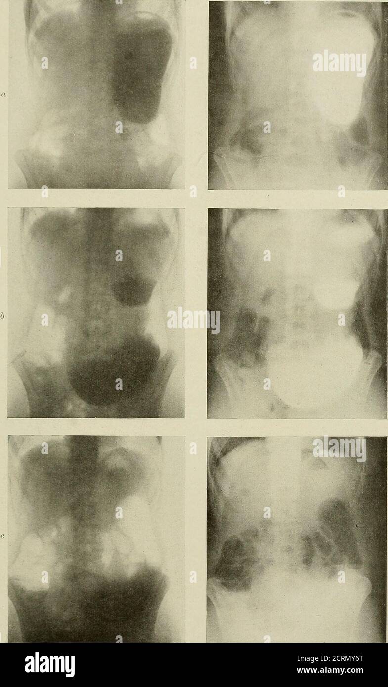 . Radiography and radio-therapeutics . Fig. 299.—Hour-glass contraction ...