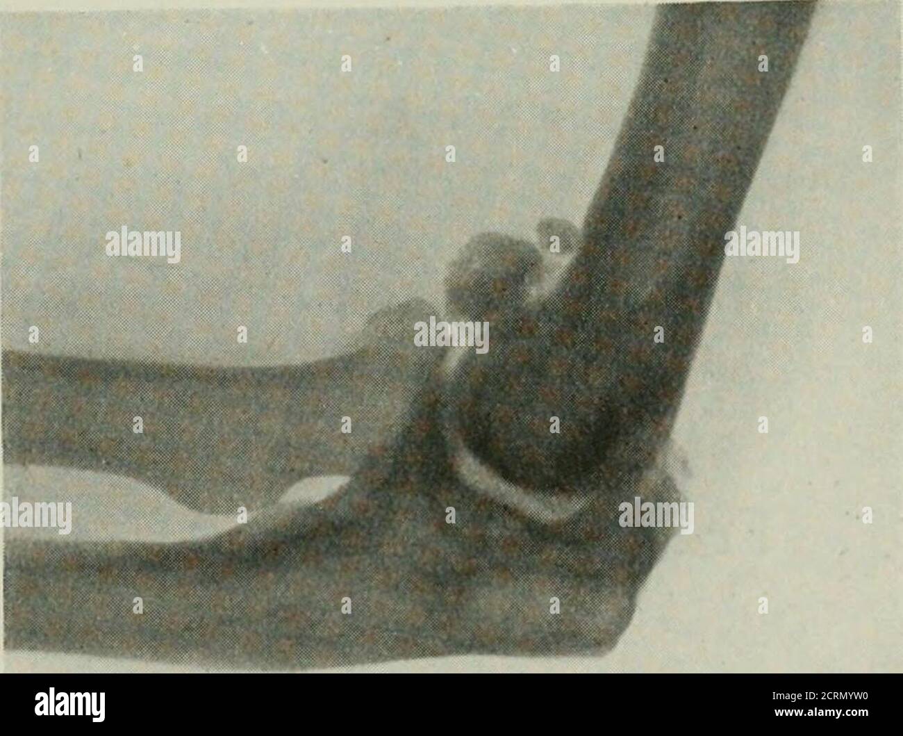 Callus formation hi-res stock photography and images - Alamy