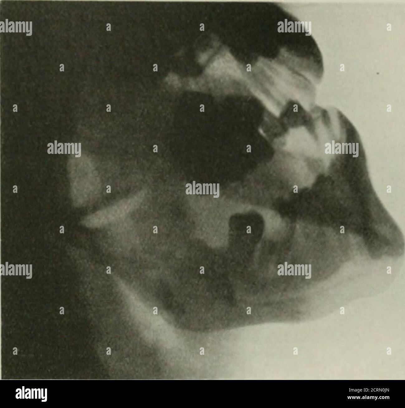 Temporal bone fracture hi-res stock photography and images - Alamy