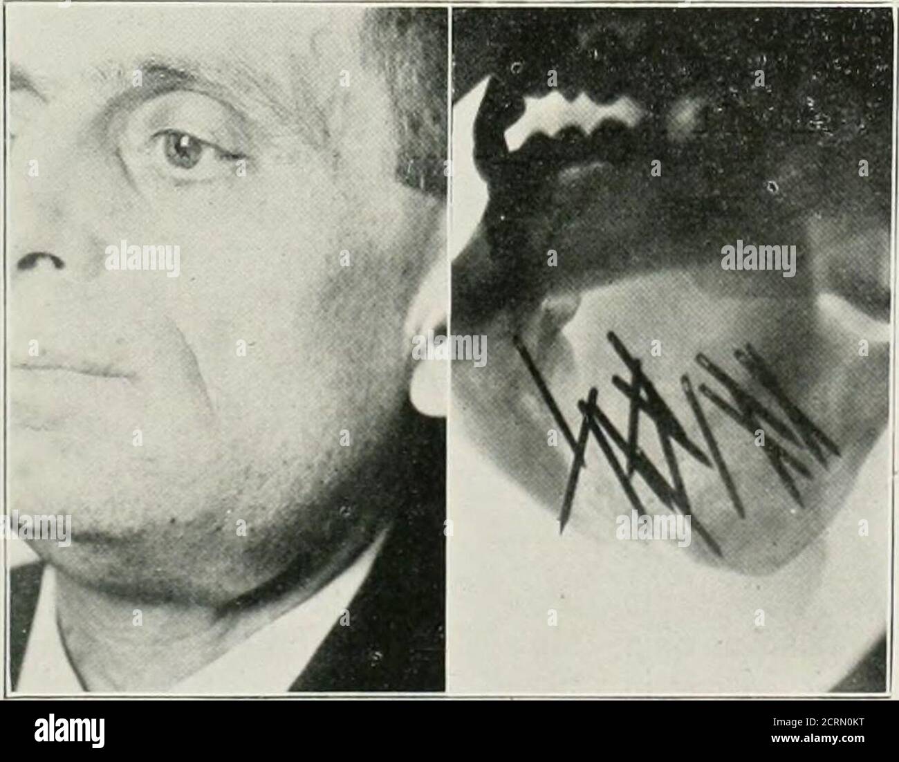 . Archives of physical medicine and rehabilitation . es. Radium needles ...