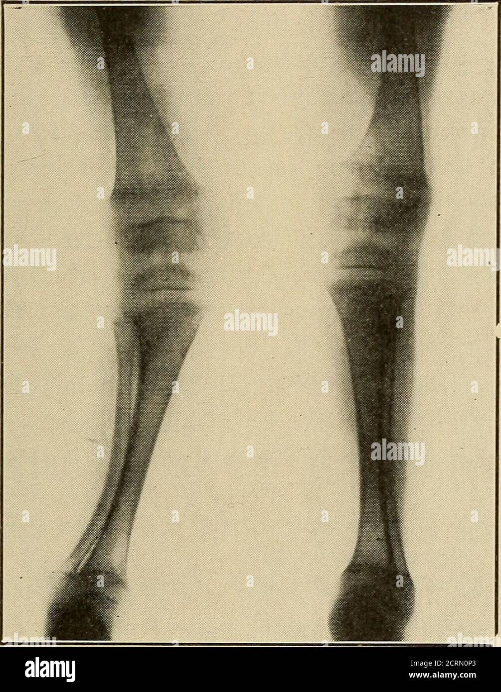 . Diseases of bones and joints . sesses a long,rounded, posterior curve ...