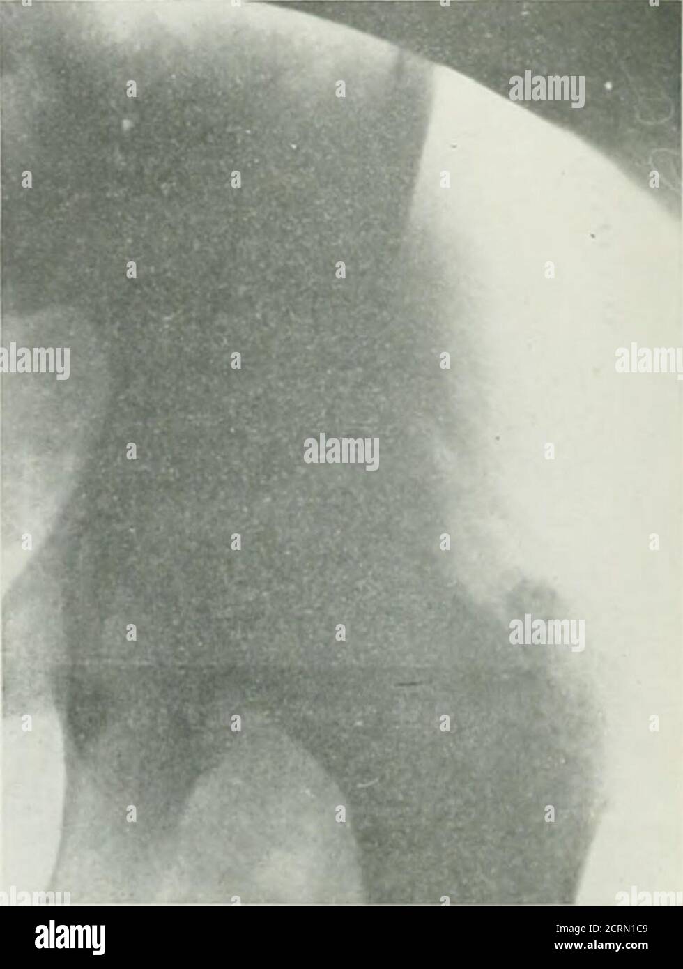 Osteoar hi-res stock photography and images - Alamy